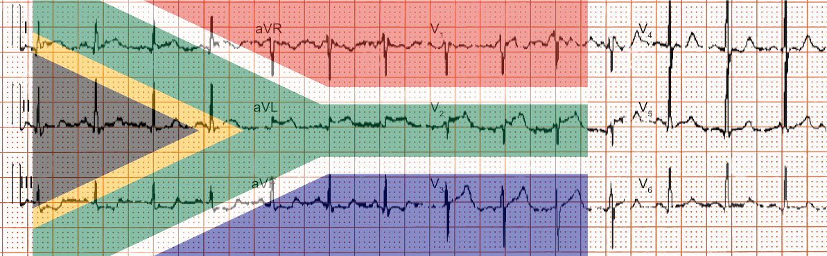 EKG – SmartEKG